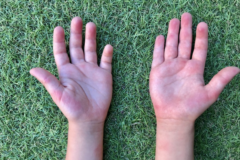 Pulpitis de las piscinas: una lesión de la piel muy común en los niños ...