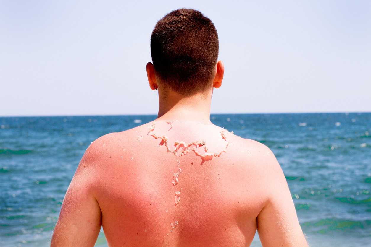 Qué hacer si te has quemado