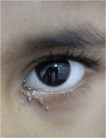 Verrugas, ¿qué hacer con ellas?