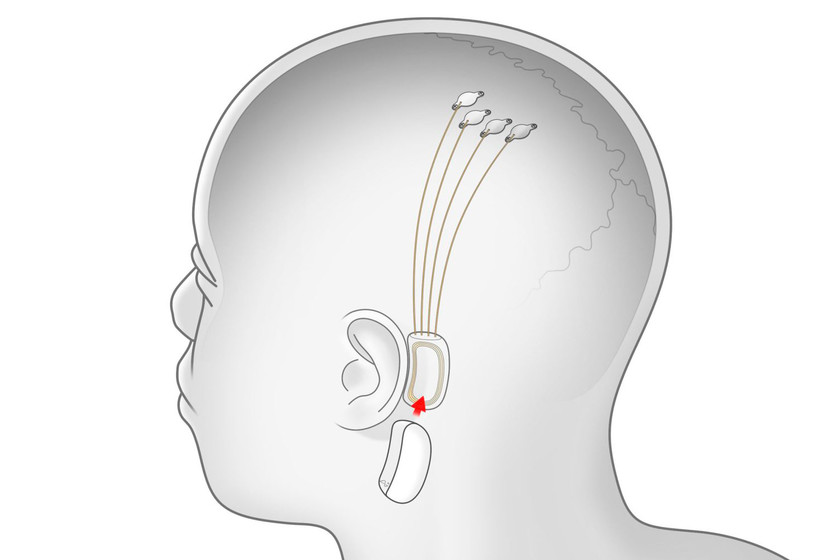 Neuralink El Proyecto De Elon Musk Que Busca Conectar Nuestros