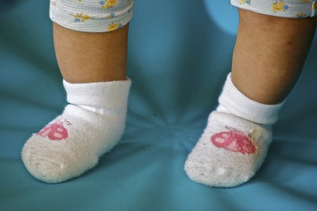 El reflejo del paso o de la marcha automática