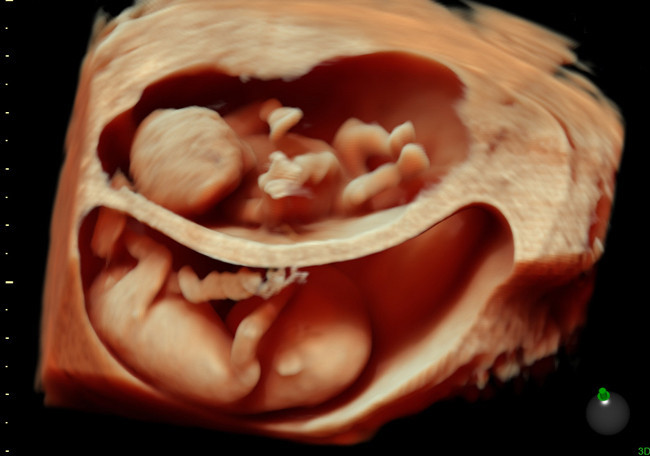 Increíbles imágenes que muestran cómo serán las nuevas ecografías en 3D