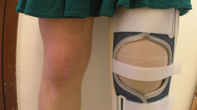 Todo sobre la rodilla (XIII): Luxación de rótula