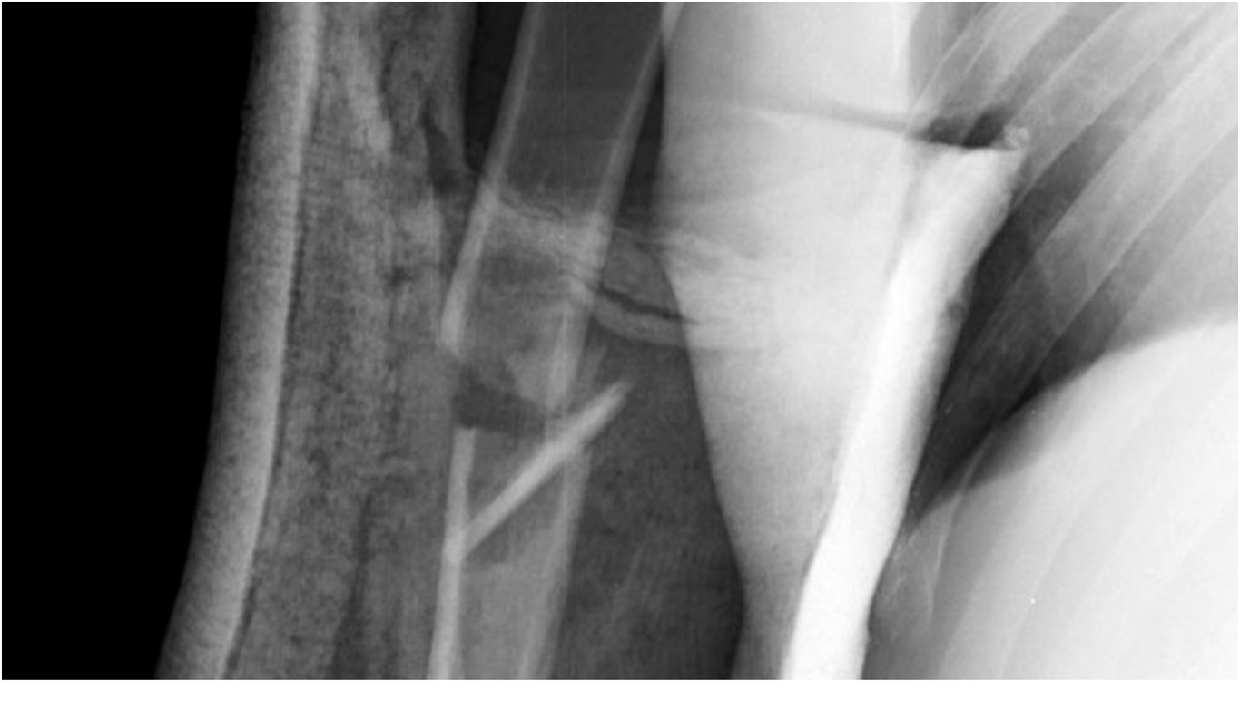 Fracturas, tendinitis, dislocaciones y roturas musculares: así son las ...