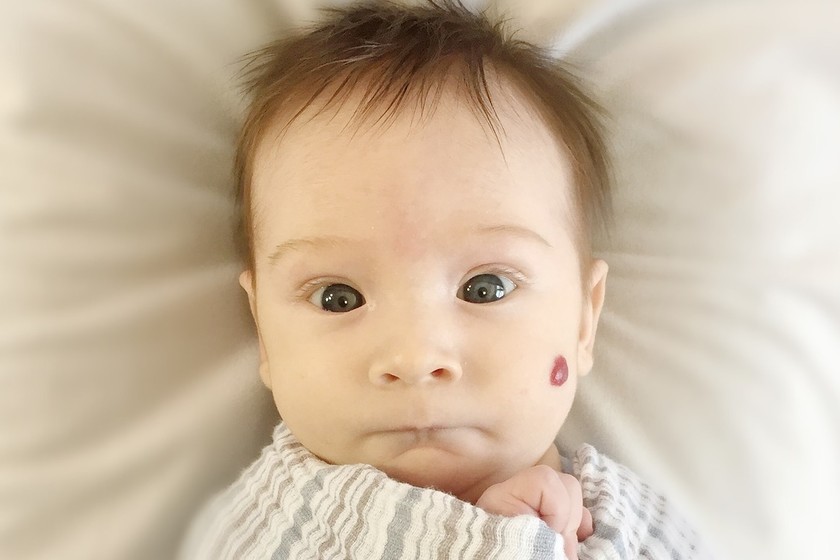 Angiomas o hemangiomas en bebés y niños: por qué se producen y cómo se ...