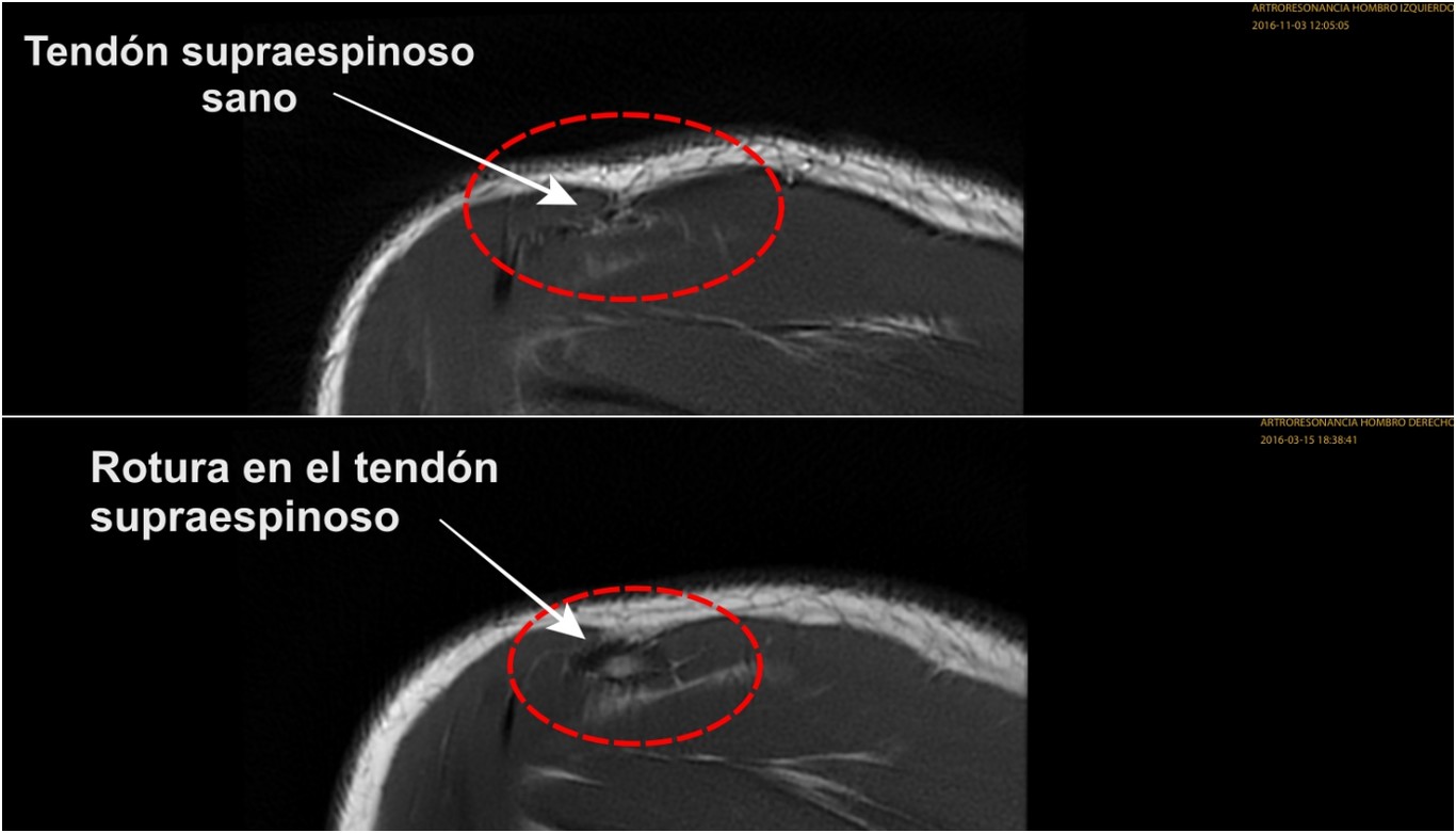 Fracturas, tendinitis, dislocaciones y roturas musculares: así son las ...