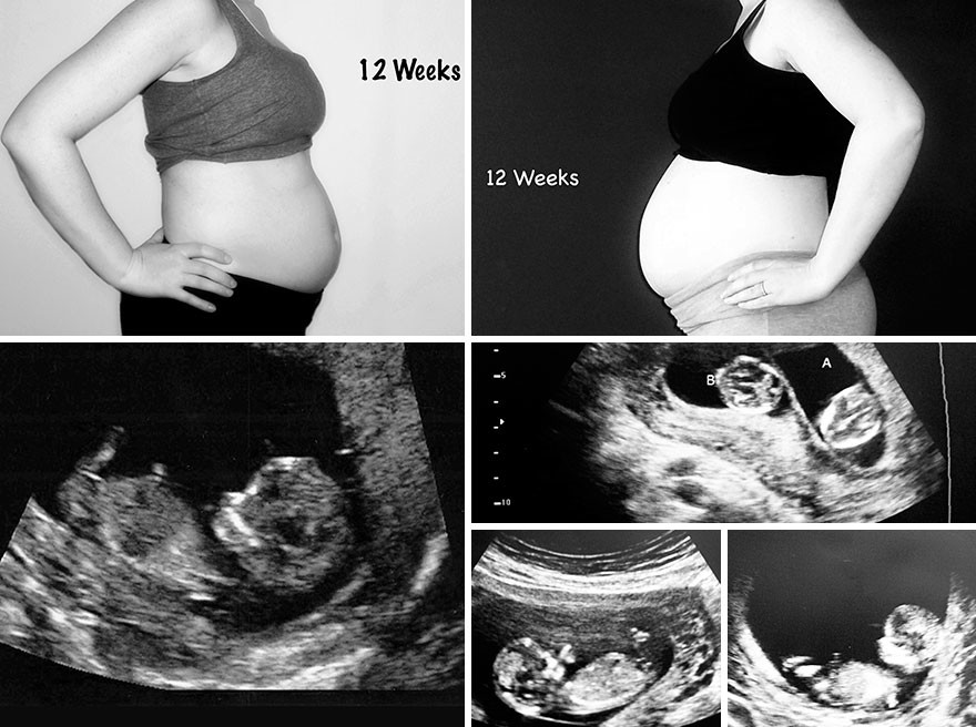 Una madre muestra en fotos las diferencias entre su primer embarazo y ...