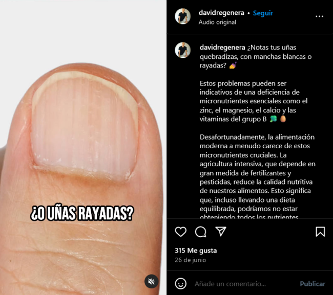 Qué significa tener las uñas rayadas y los principales motivos