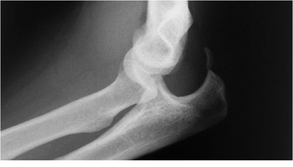 Fracturas, tendinitis, dislocaciones y roturas musculares: así son las ...