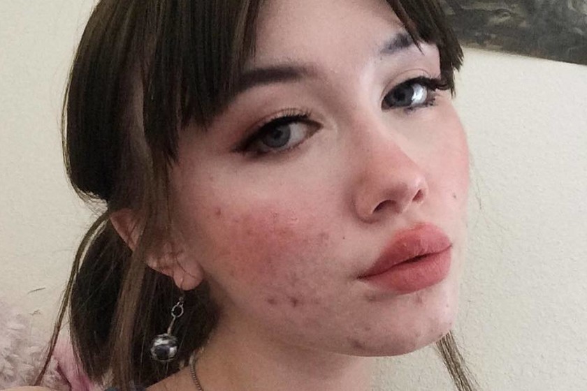 El acné pasa de esconderse y se convierte en la nueva tendencia beauty ...