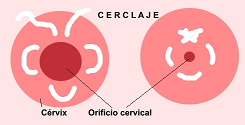 Insuficiencia cervical