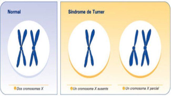 Sindrome de Turner